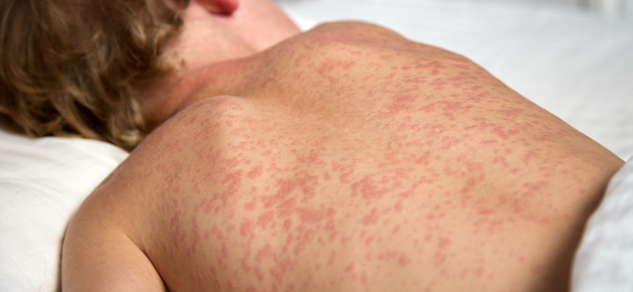 sarampo (2).png — Ministério da Saúde