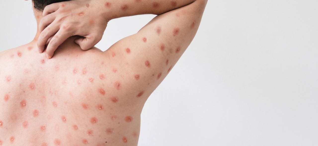 Vacina da mpox não contém vírus capaz de causar a varíola bovina ...