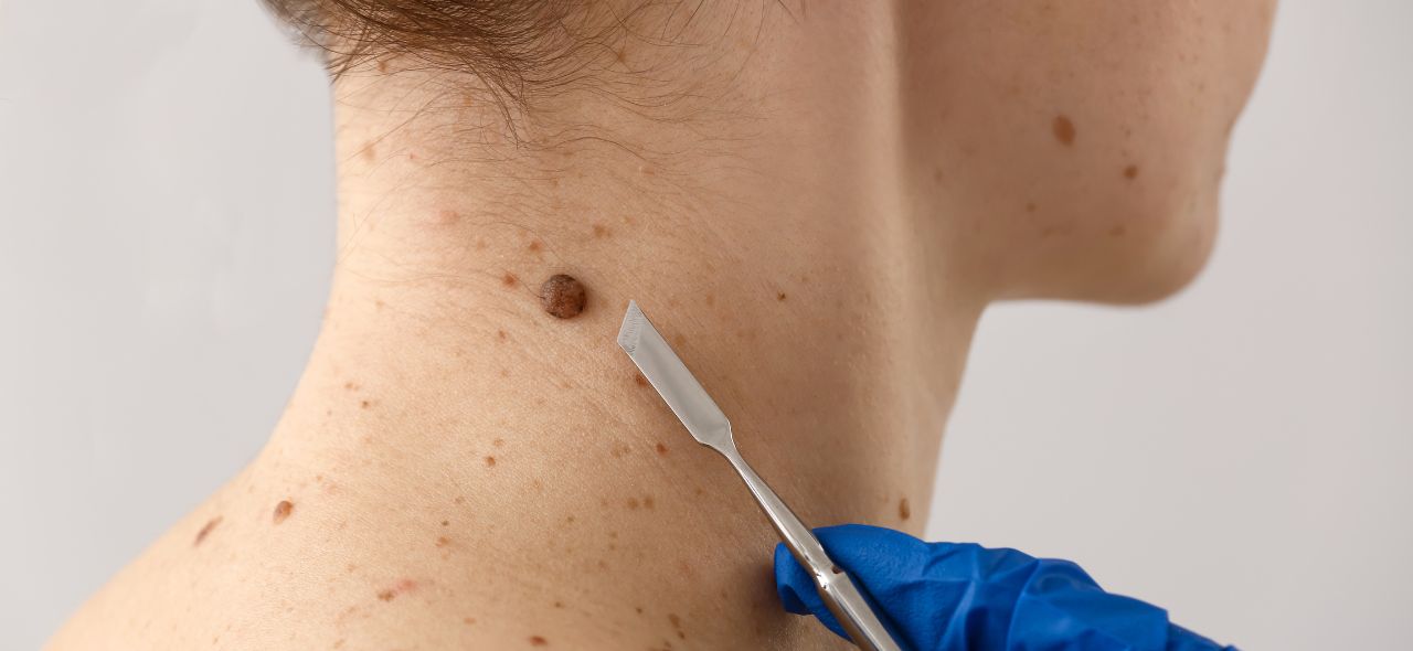 Câncer de pele representa 30% de todos os tumores malignos registrados ...